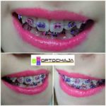 10 good reasons to choose purple braces | Braces Explained