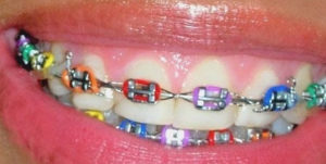 Braces Colors: Which One Is Best For You | Braces Explained